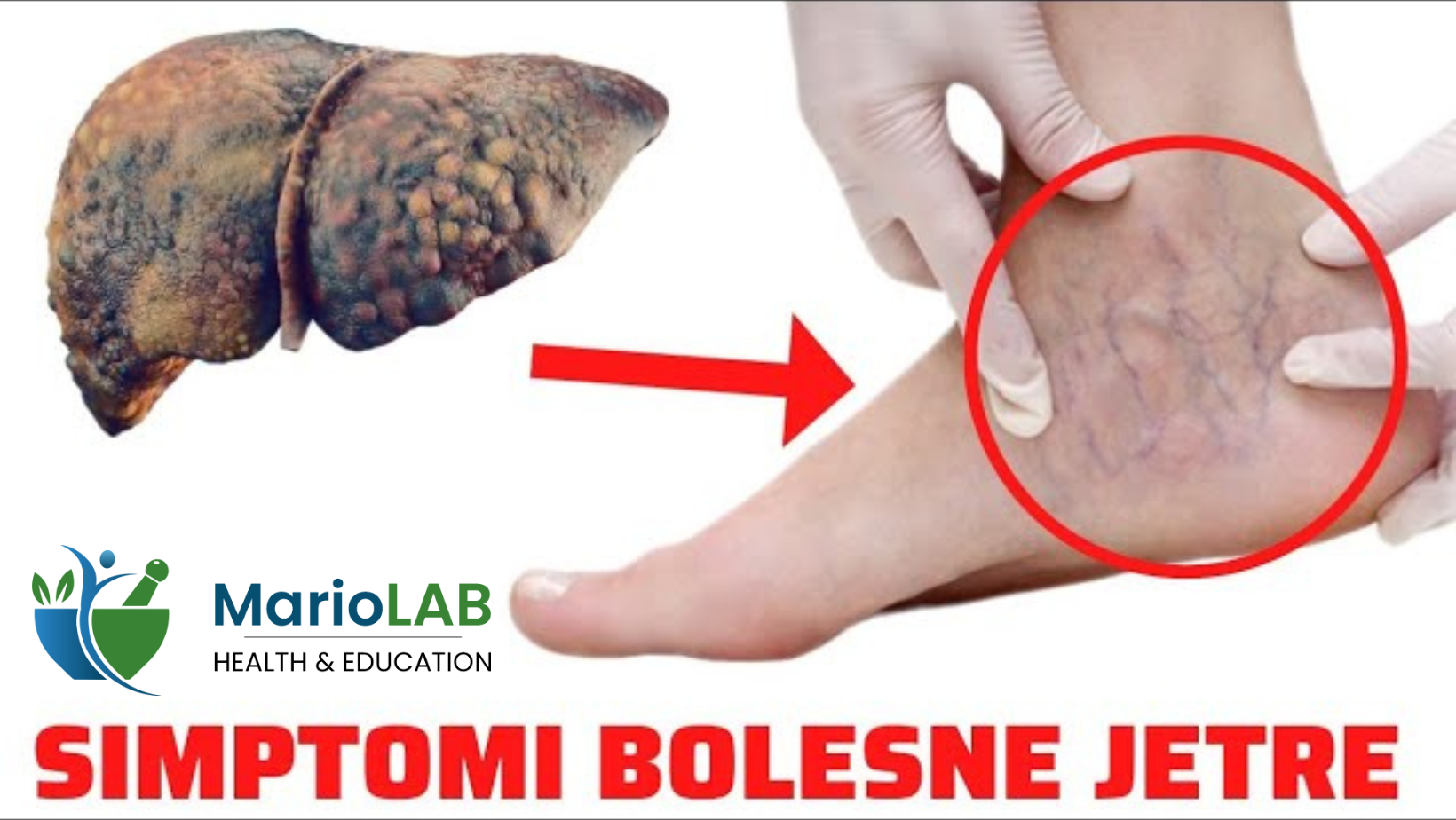 What are the symptoms of a diseased liver on the feet? - MarioLAB