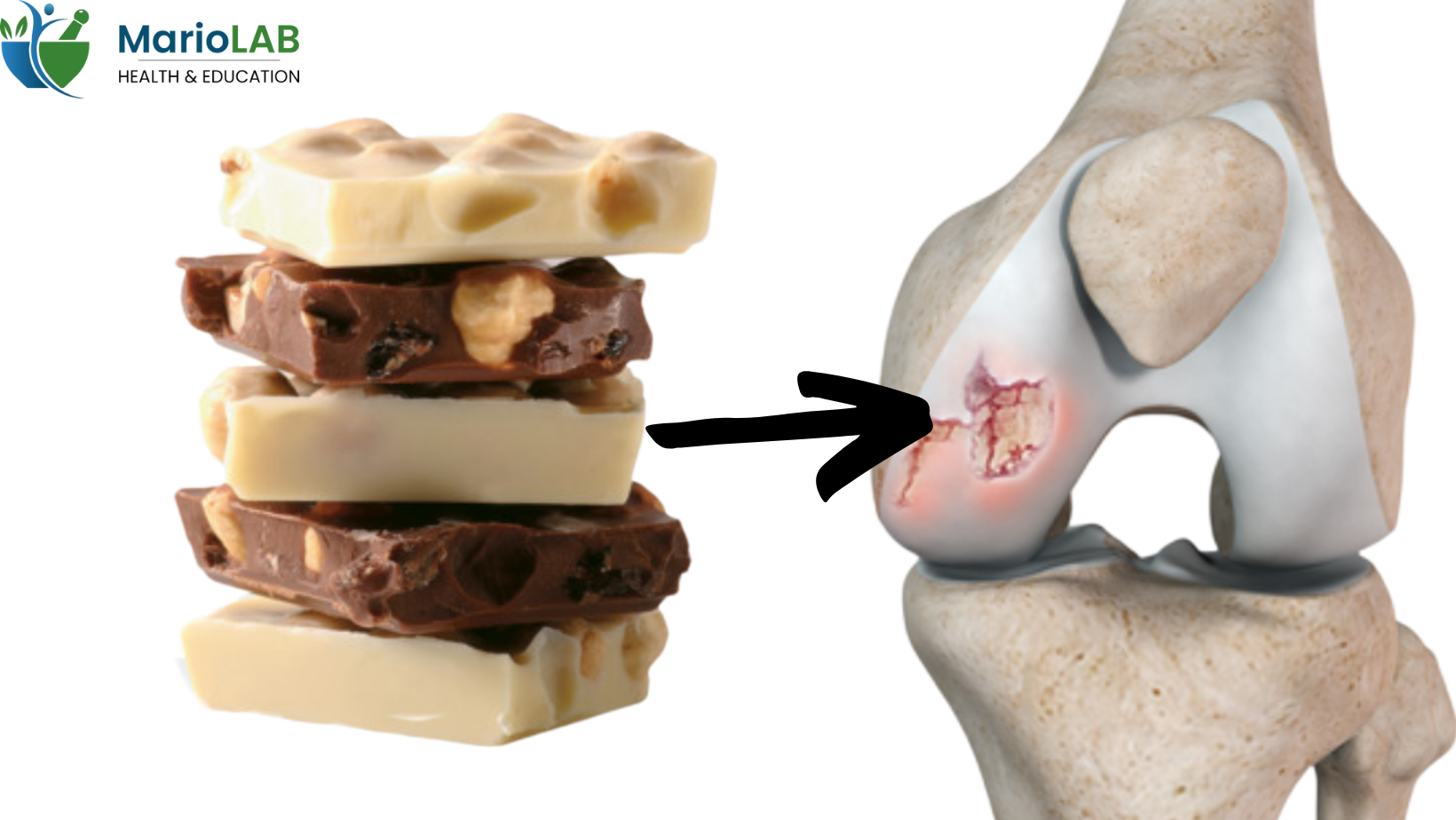 The worst food for knee cartilage! Causes inflammation, pain, swelling ...
