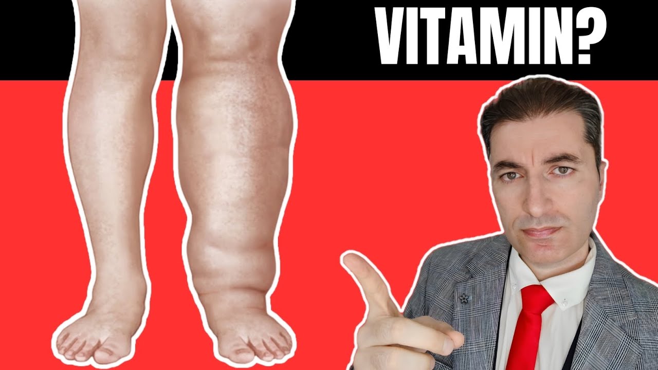 What is the most important vitamin for removing swelling of the arms ...