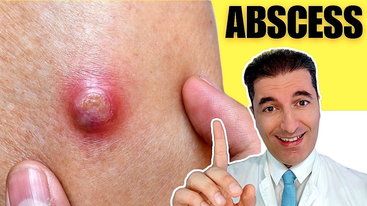 APSCES ( GNOJNI ČIR ): uzroci, simptomi, prirodno liječenje - MarioLAB