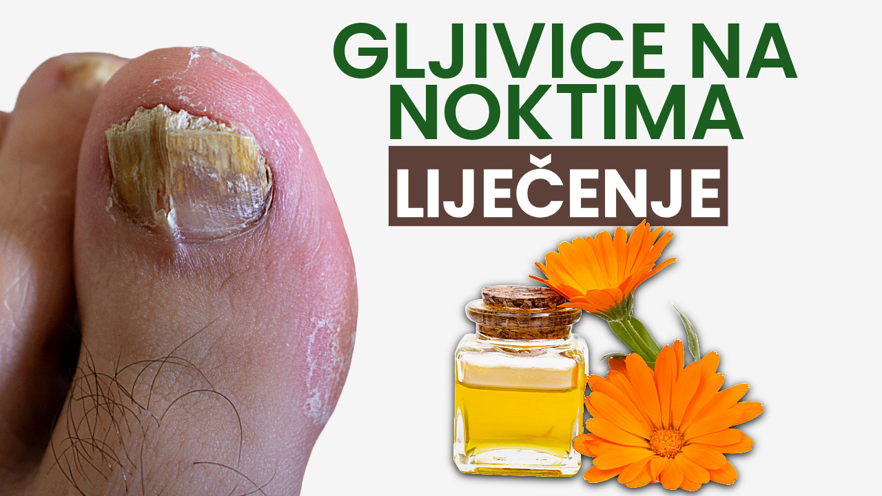 Calendula (Calendula officinalis): Natural Remedy for Fungal Foot ...